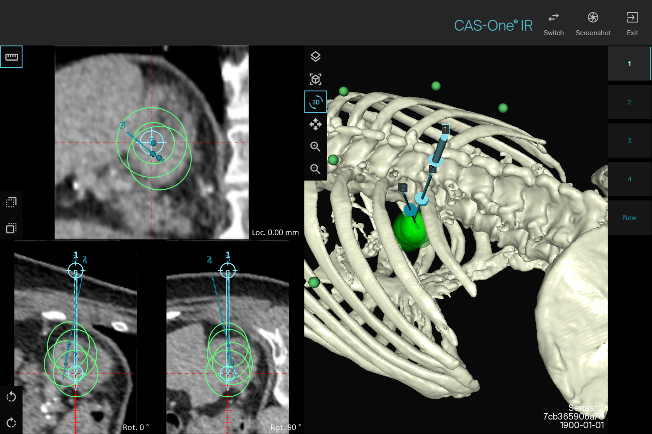 RCC pull-back microwave ablation with two trajectories and four ...