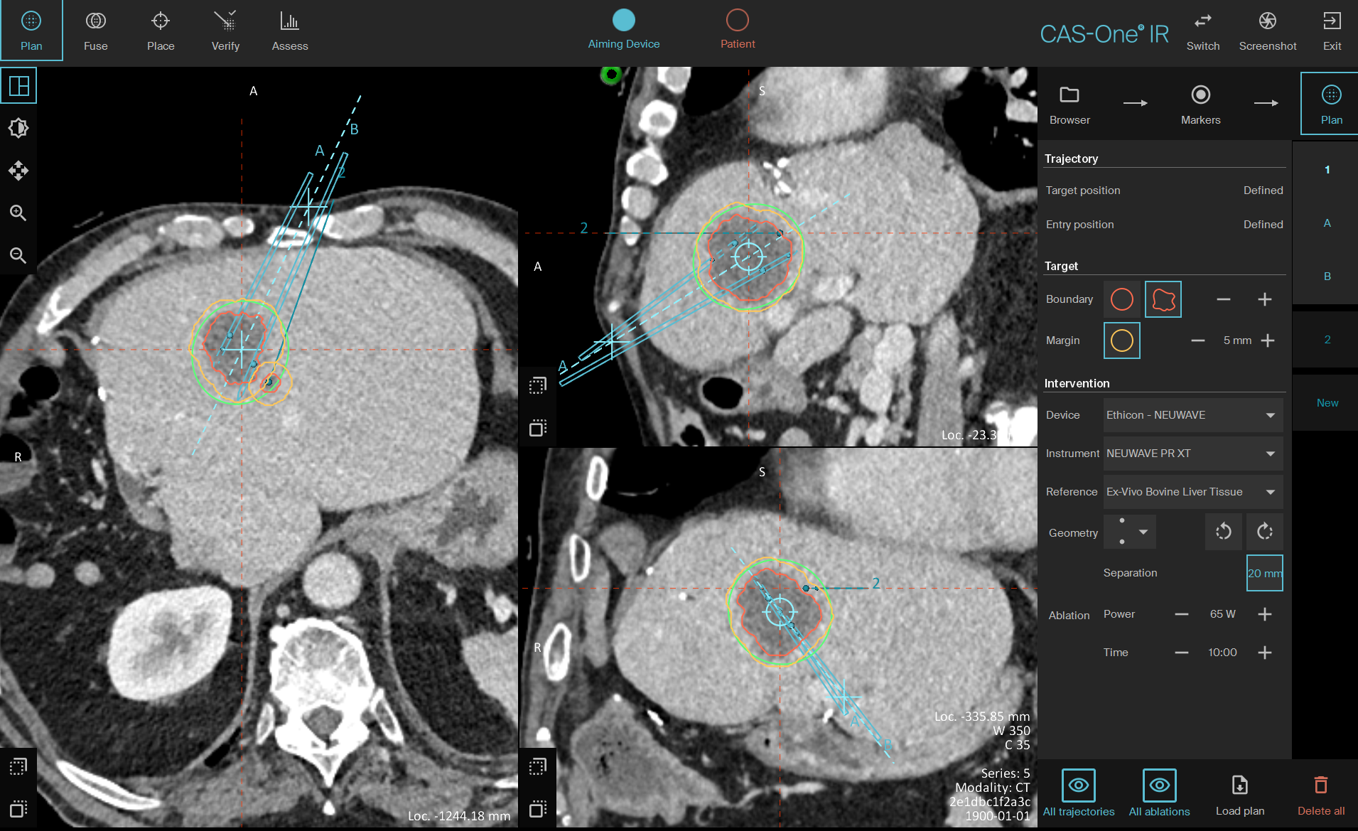 Two probe microwave ablation of a large liver metastasis