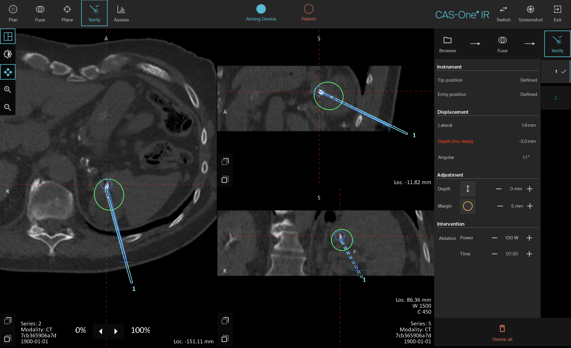 RCC pull-back microwave ablation with two trajectories and four ...