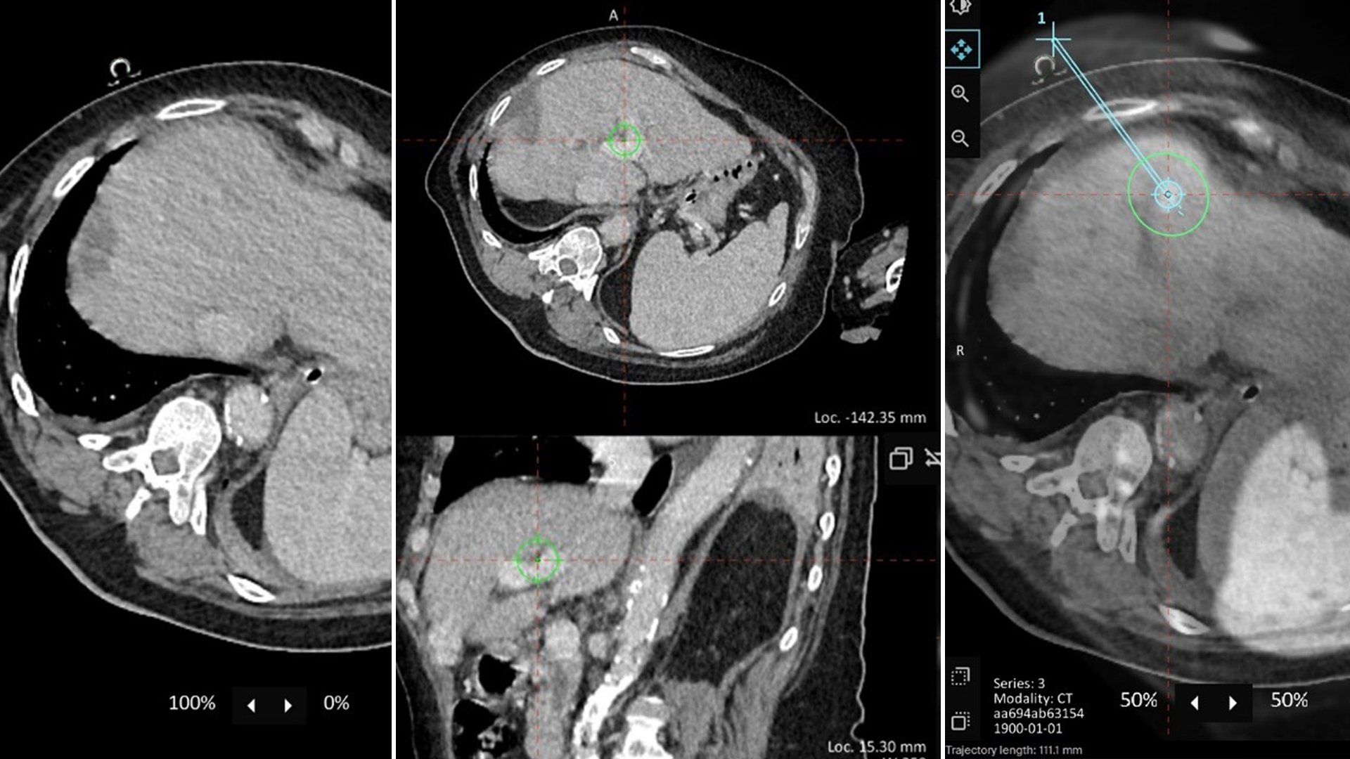 Invisible HCC lesion treated with curative intent