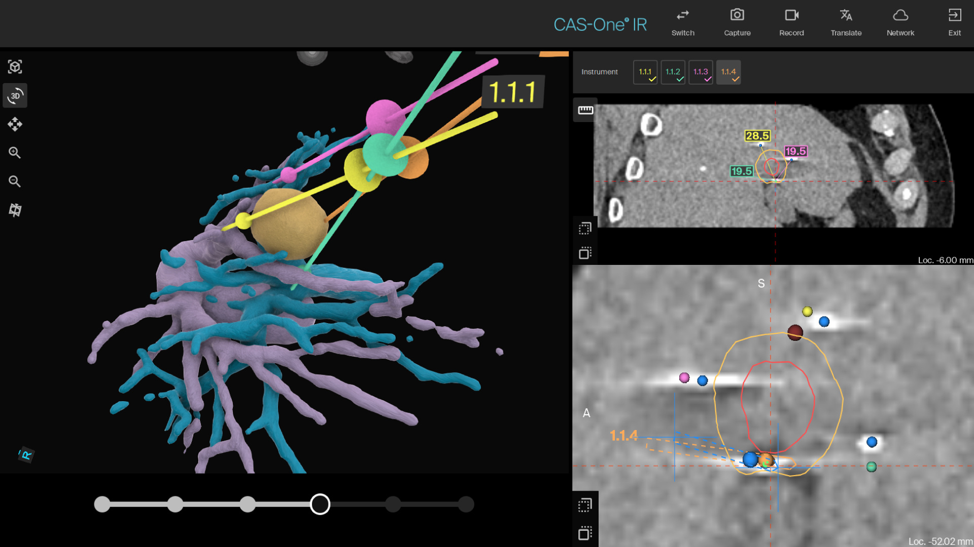 Electrochemotherapy of two lesions in segment IVa