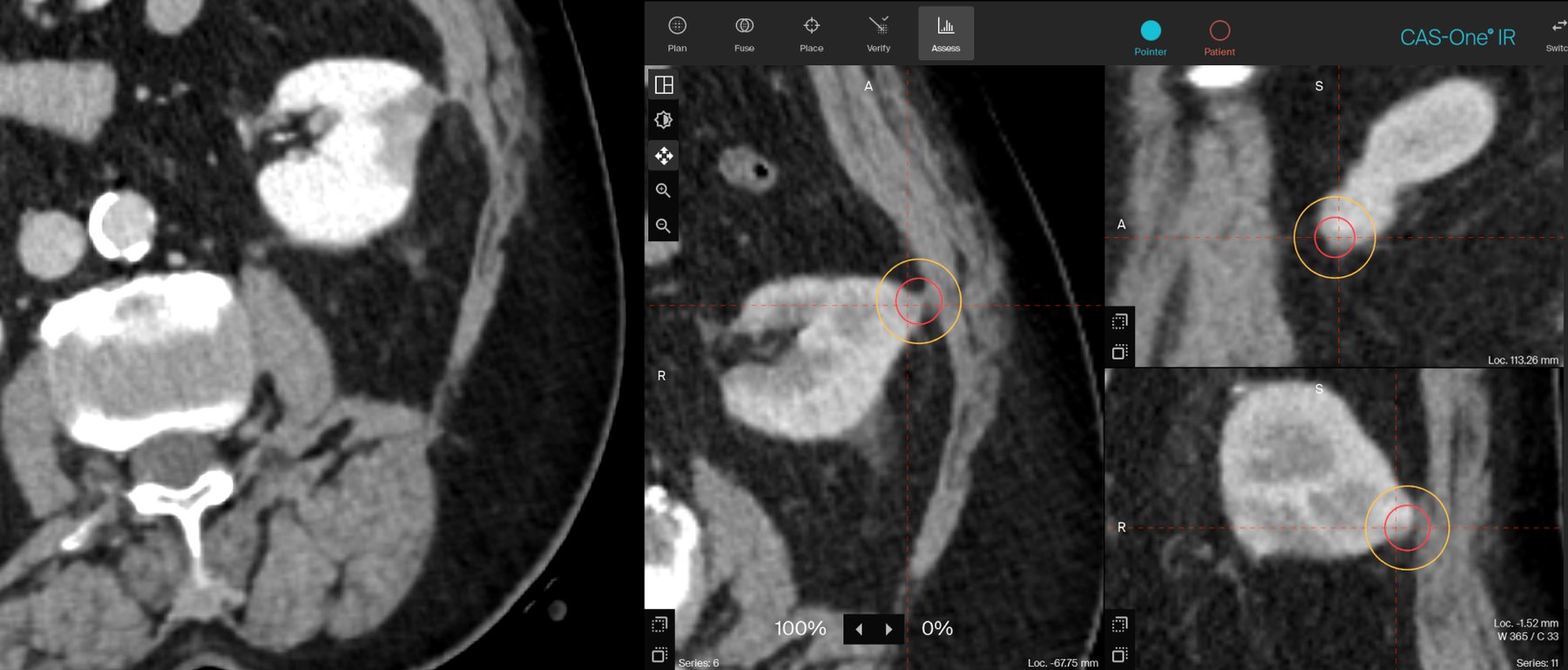 Two-probe MWA of RCC lesions in different locations