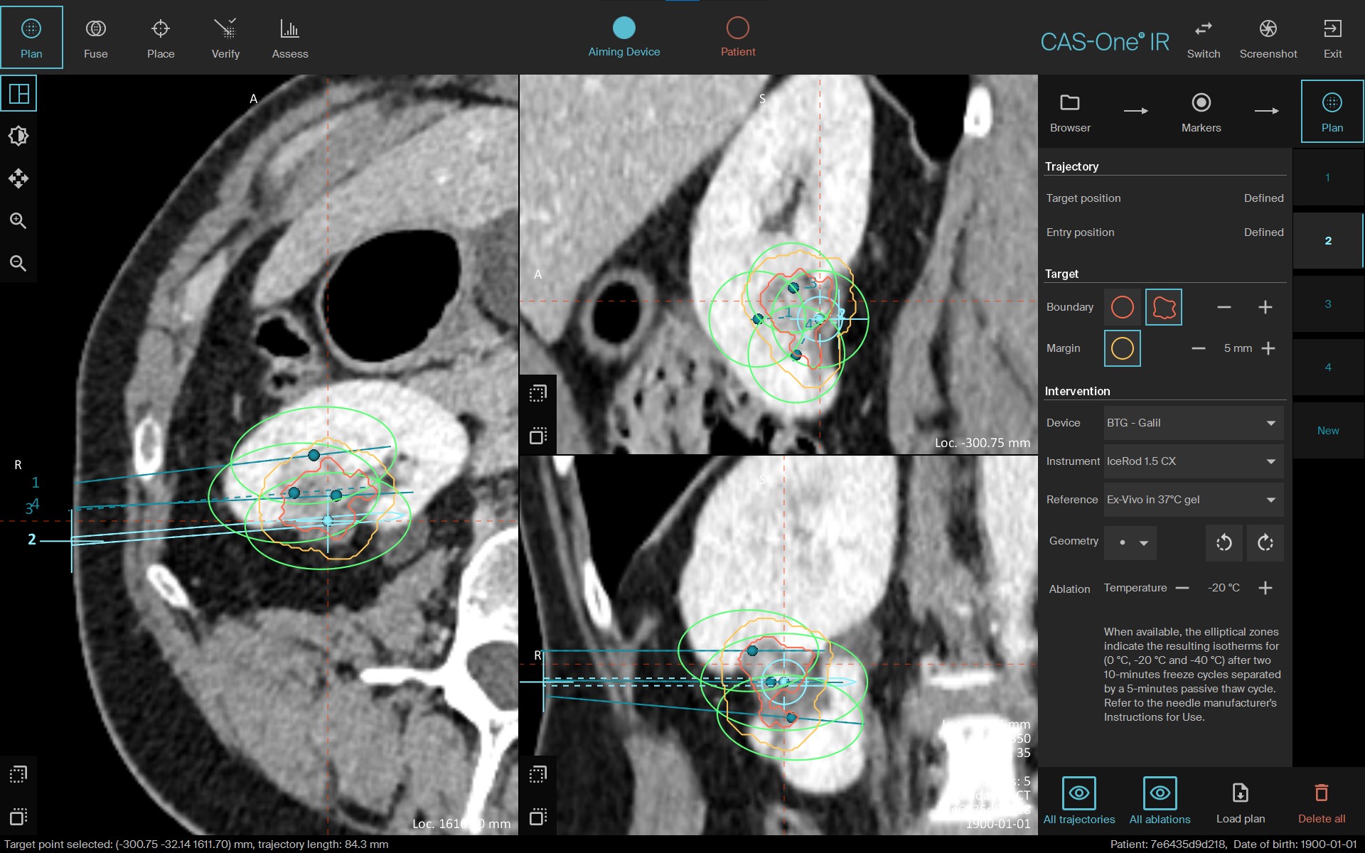 Cryoablation of large kidney lesion post-nephrectomy to preserve renal ...