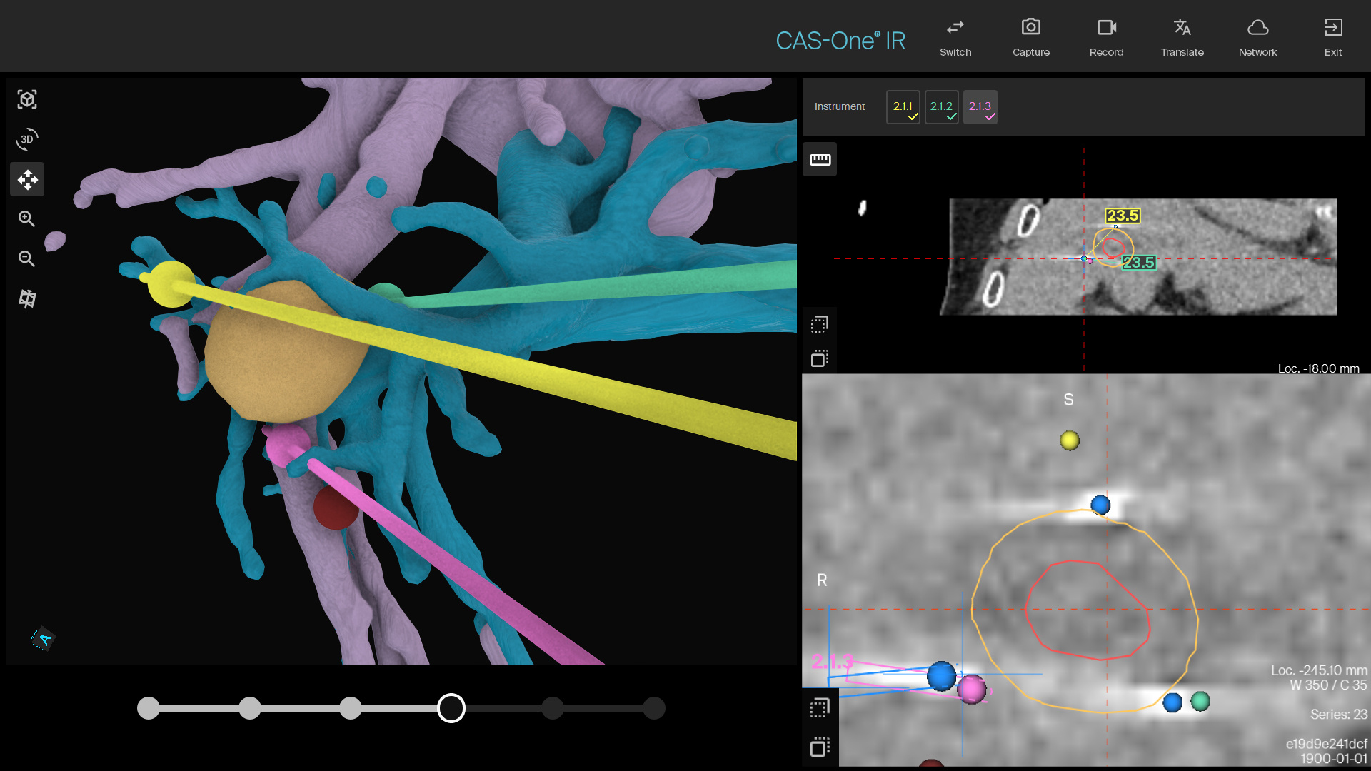 Electrochemotherapy of two lesions in segment IVa