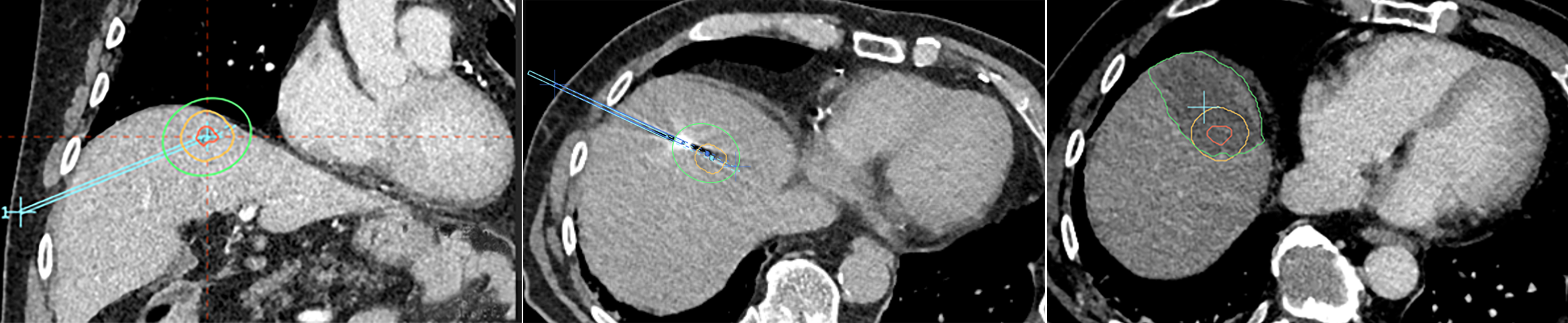 MWA in the liver dome with an inferior-to-superior oblique trajectory