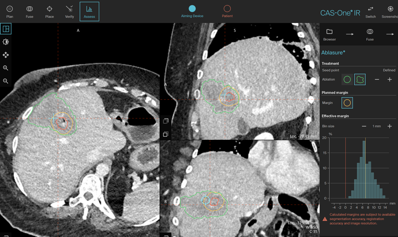 6,000 patients treated with CAS-One IR
