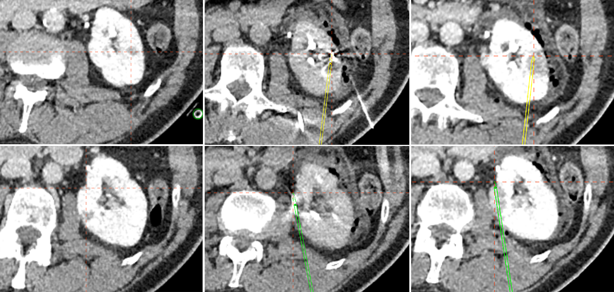 Gewebeschonende Mikrowellen- und Kryoablation einer Niere