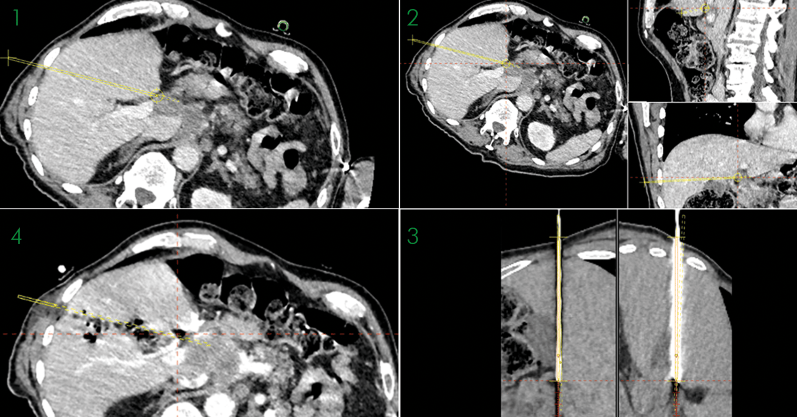 CT-Guided Biopsy in a difficult Localisation in the Liver Hilum