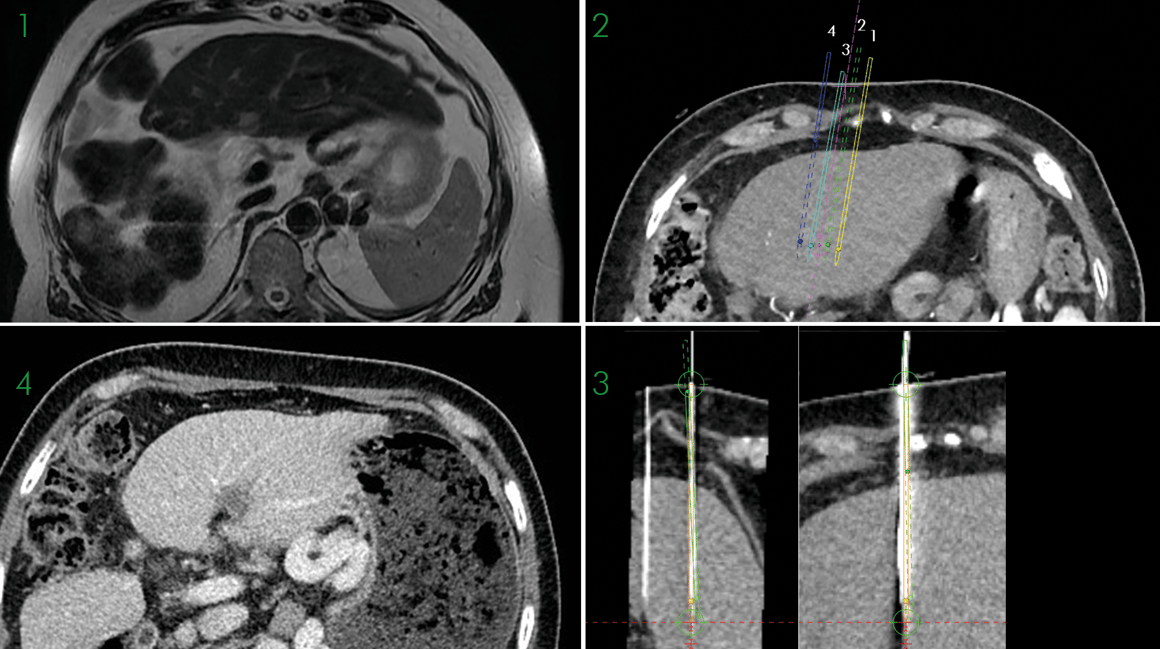 Navigated Irreversible Electroporation of Hepatocellular Carcinoma