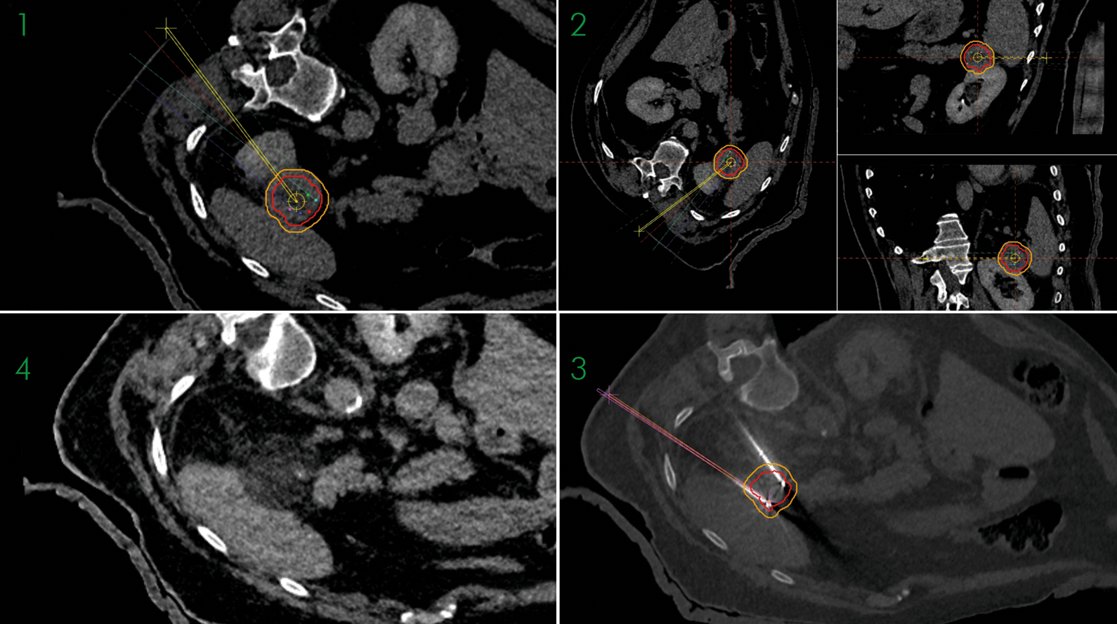 CT-gesteuerte Kryoablation eines Nierenkarzinoms