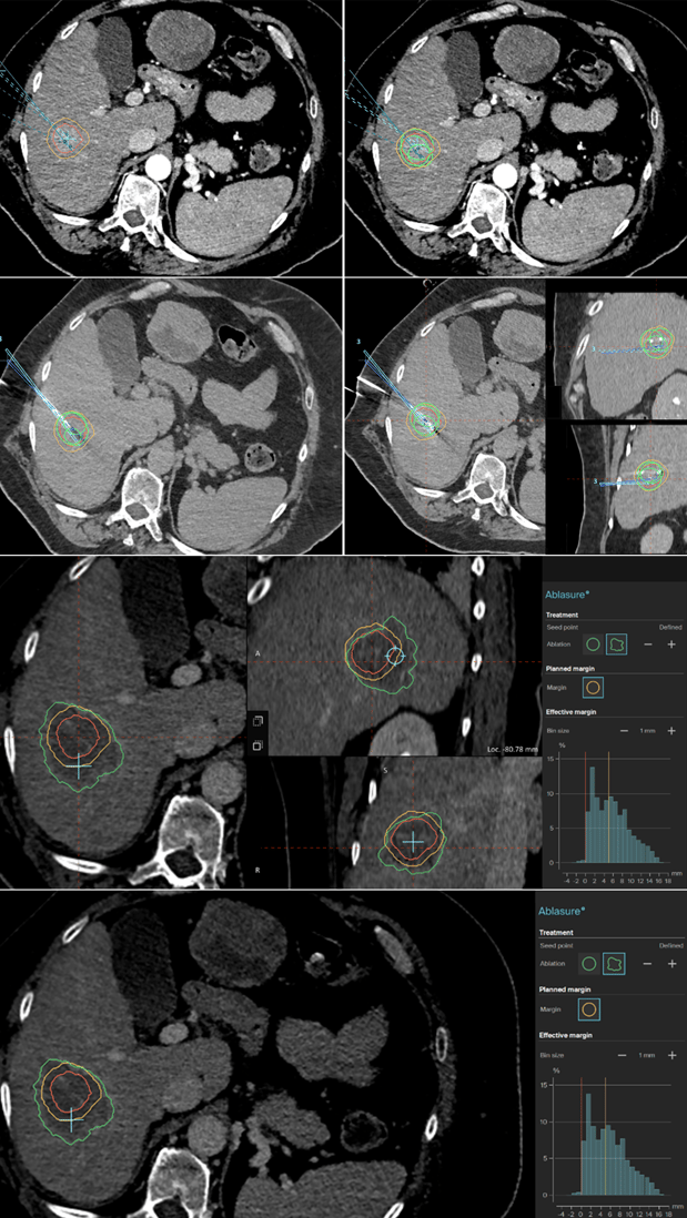 Radiofrequency ablation as bridging strategy for liver transplantation