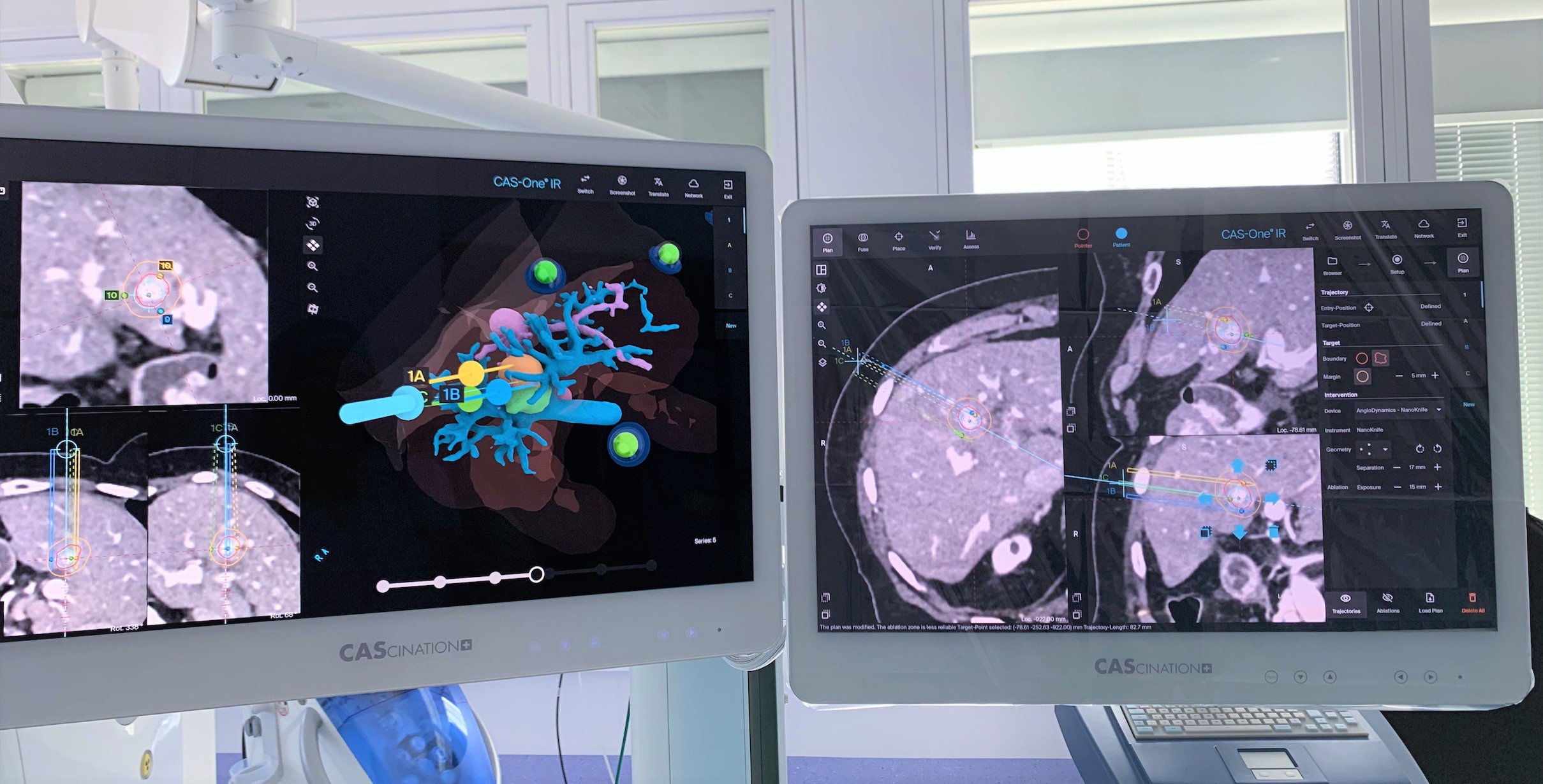 The first cases of the new AI-driven CAS-One IR are in the books!