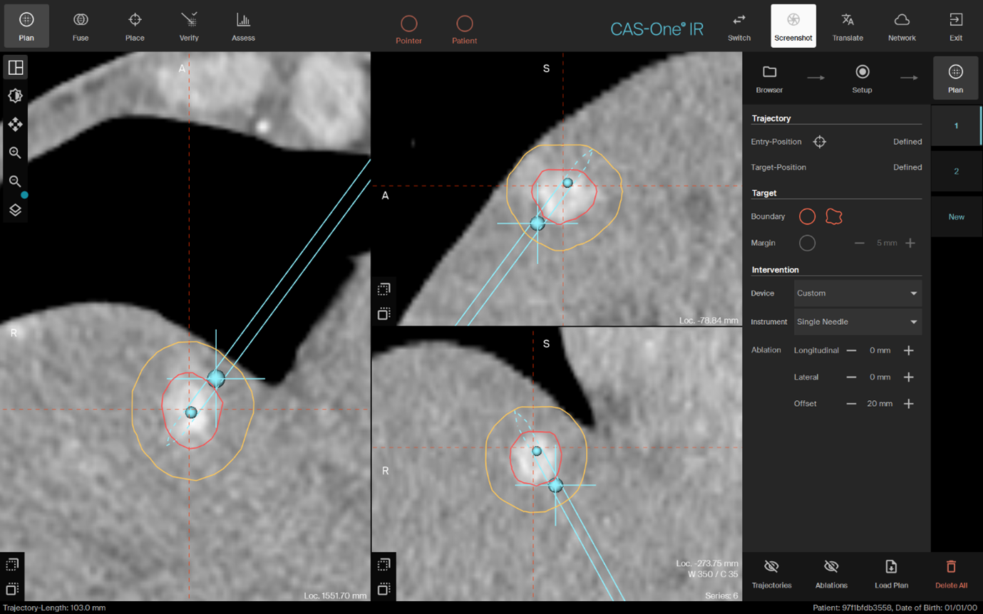 Biopsy plus MWA for a subphrenic, hypervascular neuroendrocrine liver ...