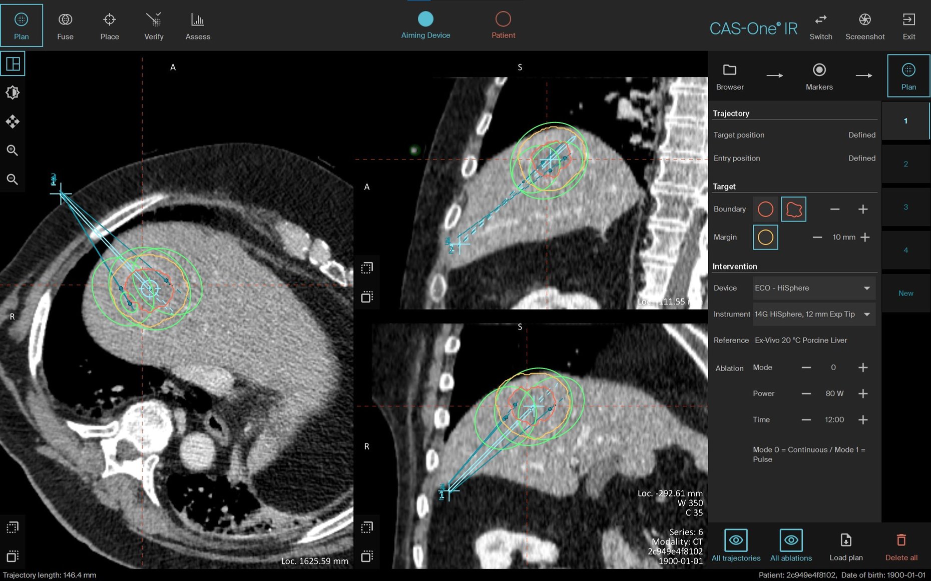 Multi-volume overlapping ablation zone of a large metastatic liver ...