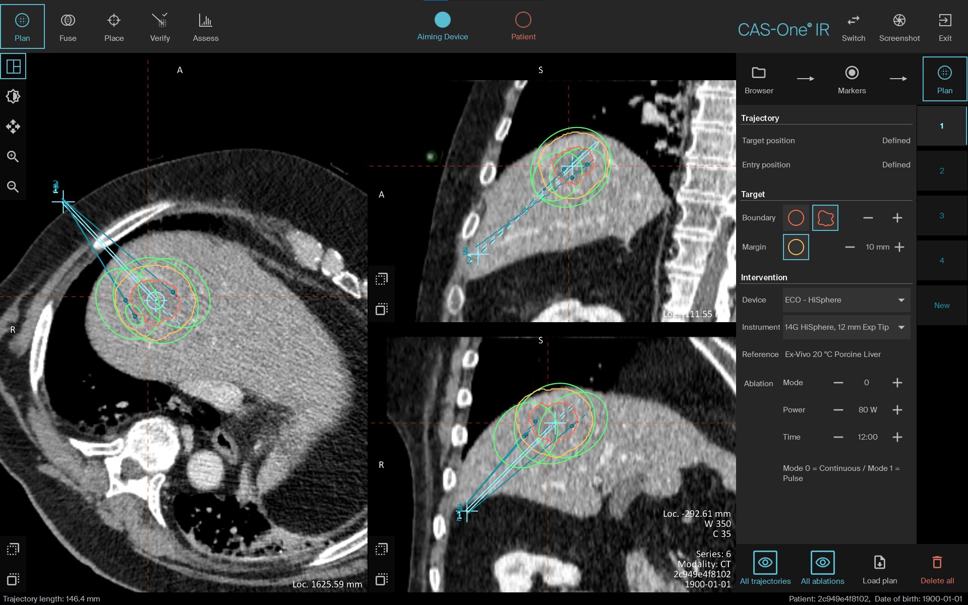 Multi-volume overlapping ablation zone of a large metastatic liver ...