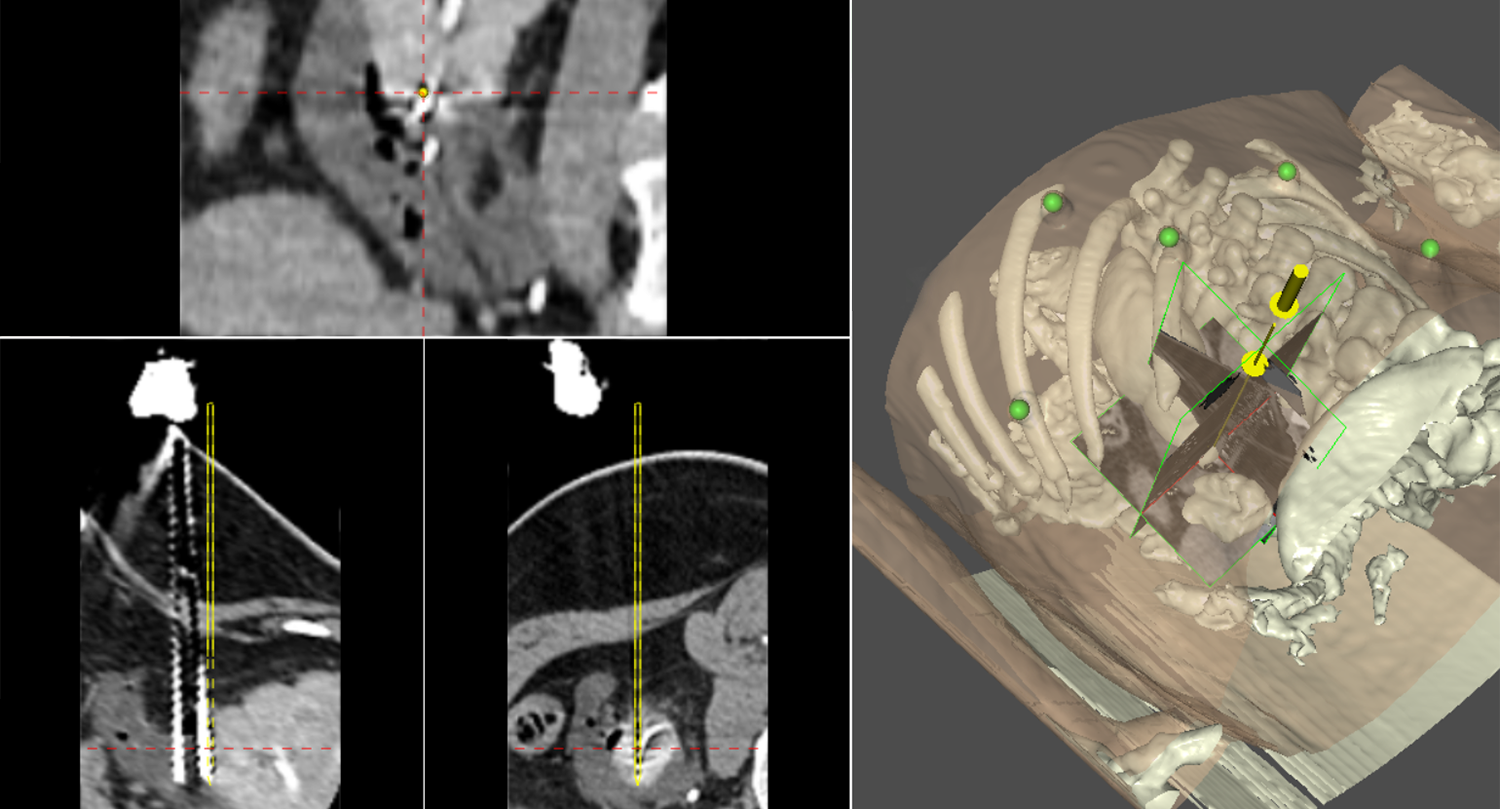 Gewebeschonende Mikrowellen- und Kryoablation einer Niere