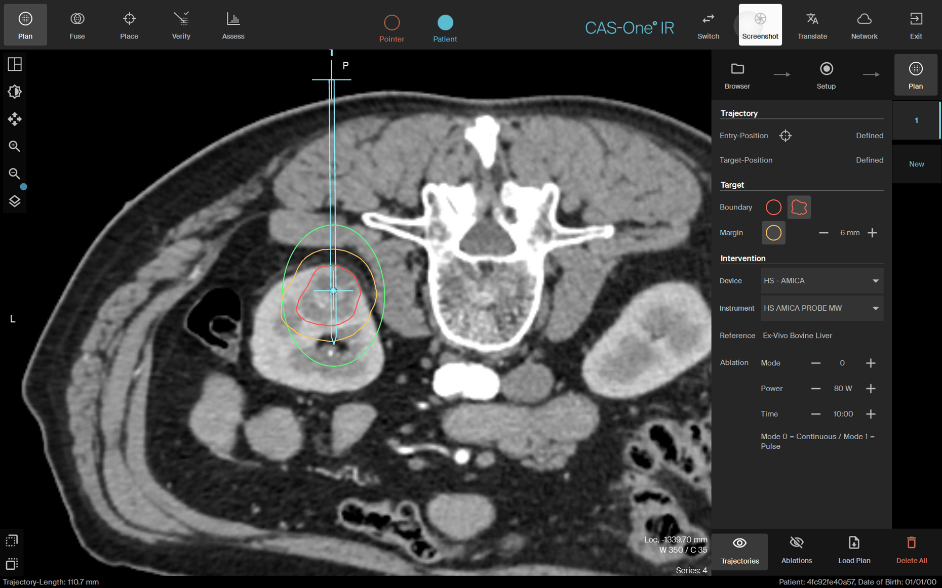MWA of the Kidney with CAS-One IR