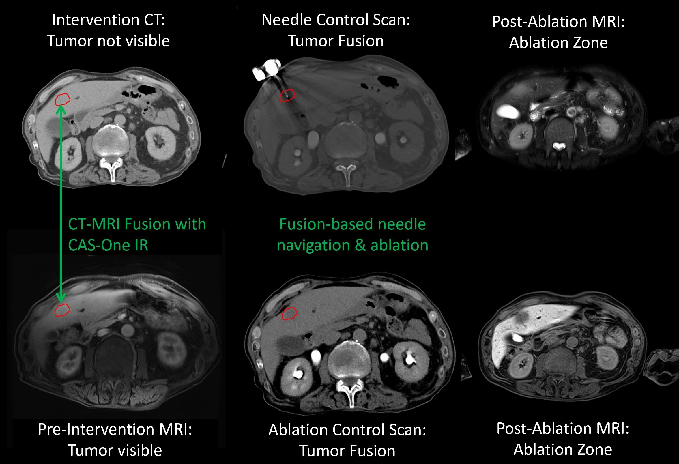 Ablation of "invisible" CRC metastasis in the liver