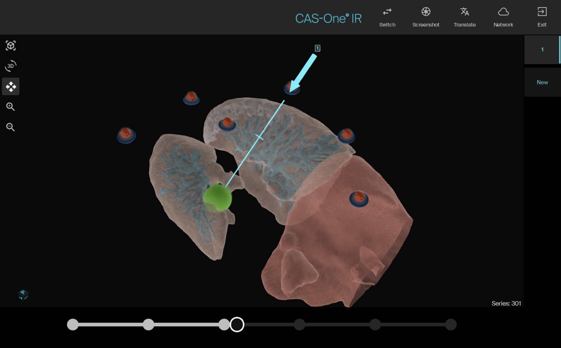 MWA of an Osteosarcoma Metastasis after a Lung Resection