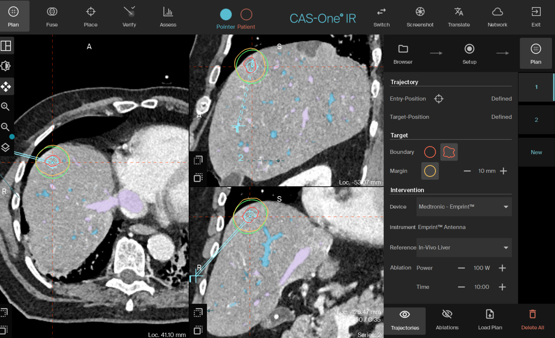 A highly angulated trajectory for a liver dome lesion on the capsule ...