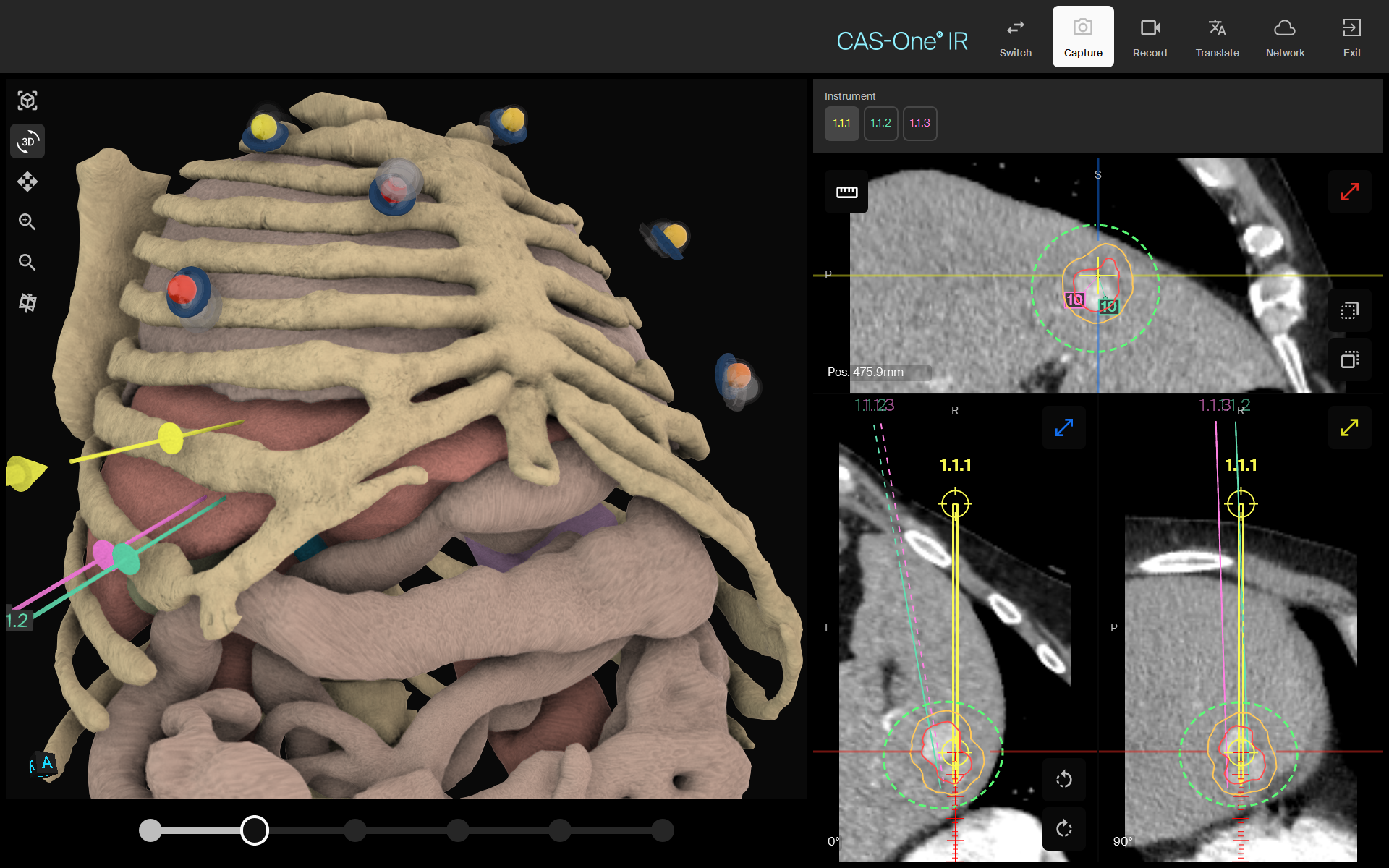 Multiple probe RFA of HCC in segment IV