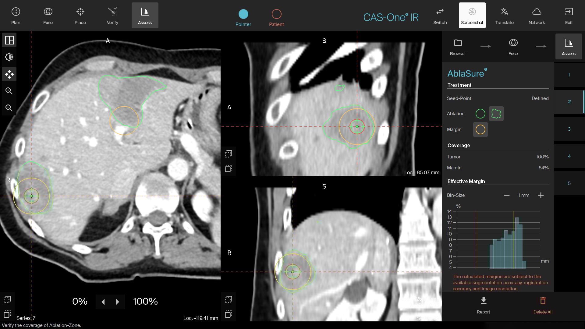 MWA of five invisible liver lesions with MRI/CT fusion