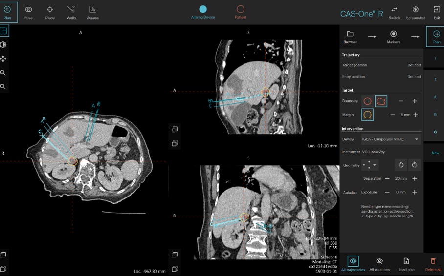 Complex 12 needle combined ECT/MWA of 8 metastatic liver lesions
