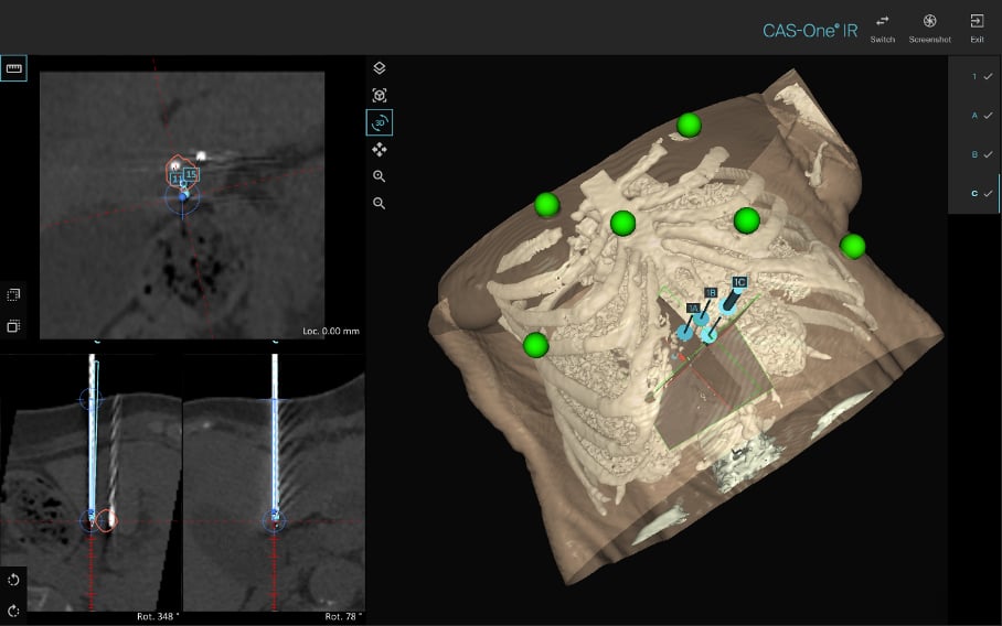 Complex 12 needle combined ECT/MWA of 8 metastatic liver lesions