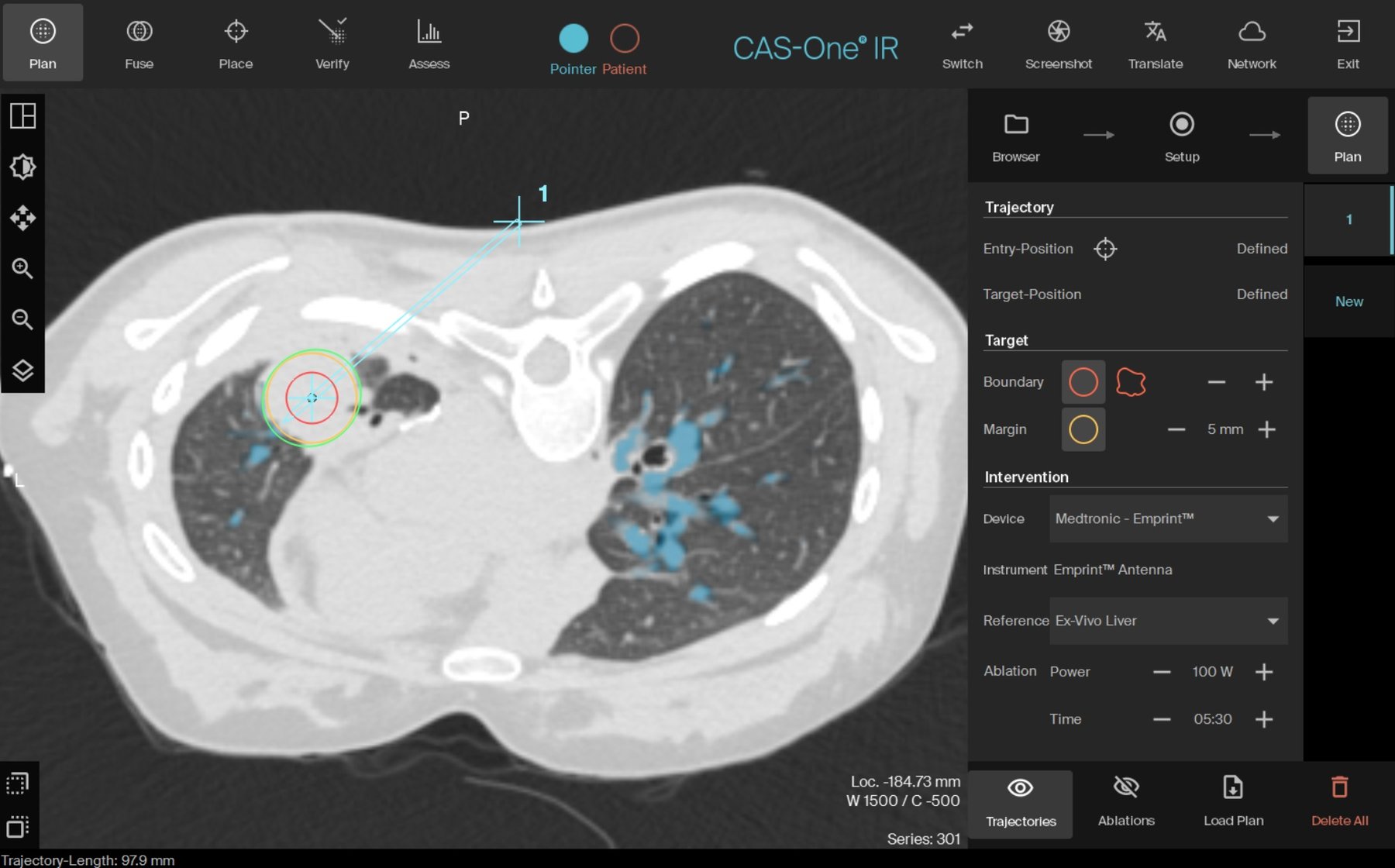 MWA of an Osteosarcoma Metastasis after a Lung Resection