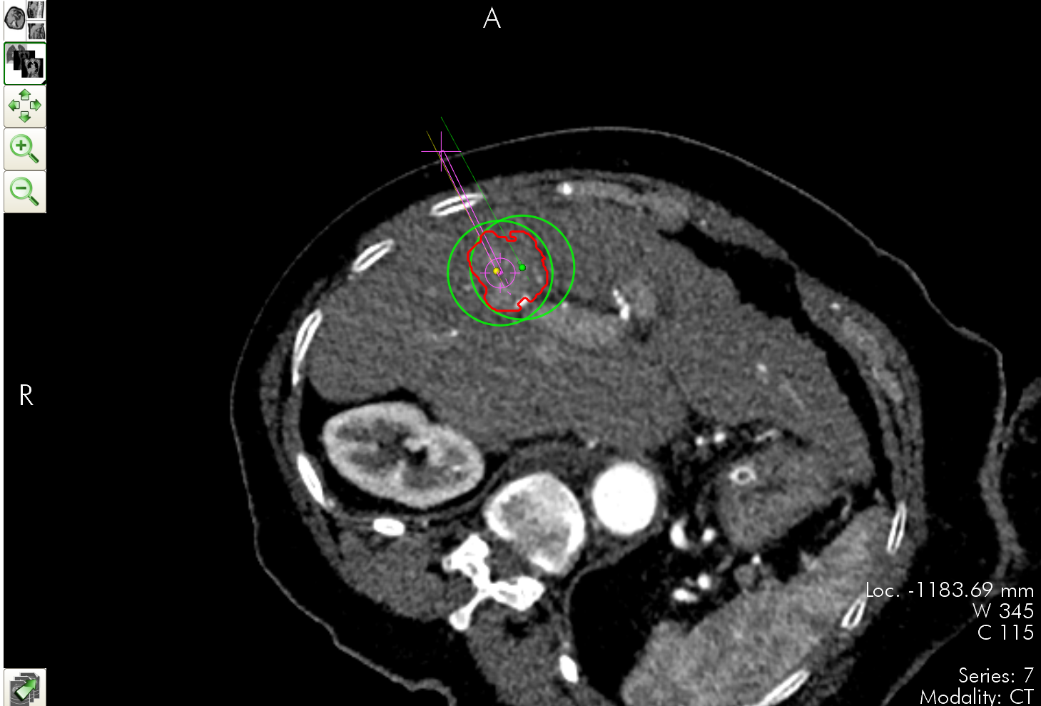 Ablation of a malignant cancer of the liver