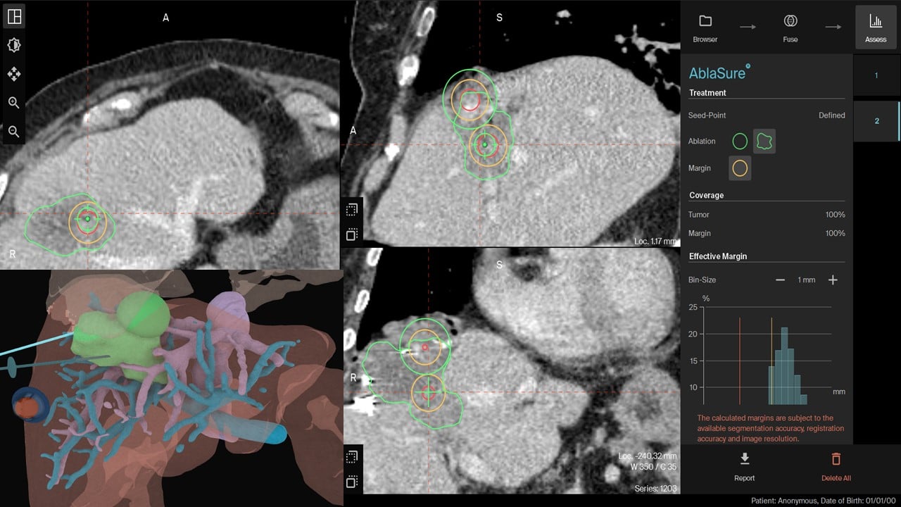 Two challenging CRLMs in segment VIII: close to the liver dome, and ...
