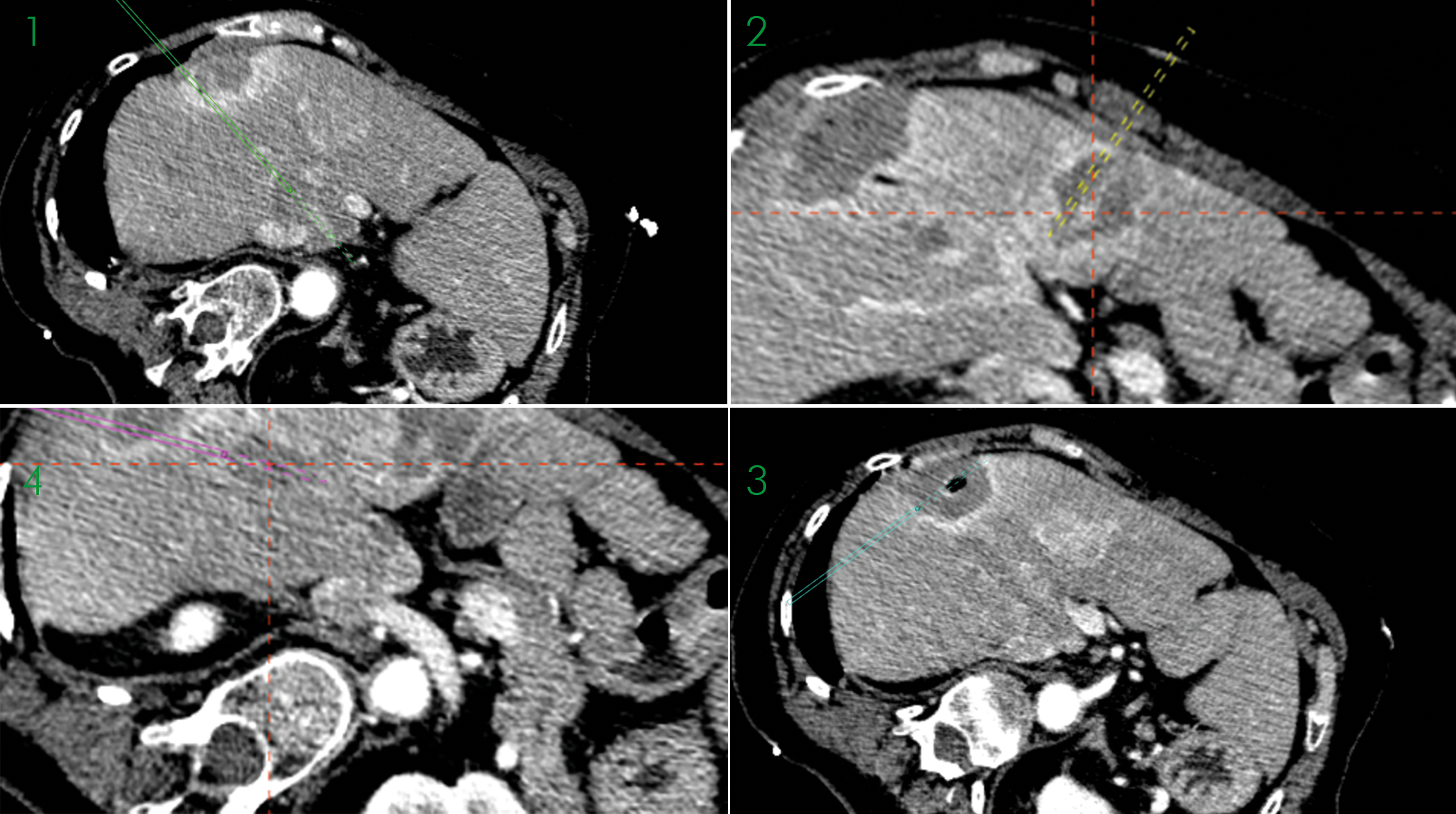 MWA in the liver dome with an inferior-to-superior oblique trajectory