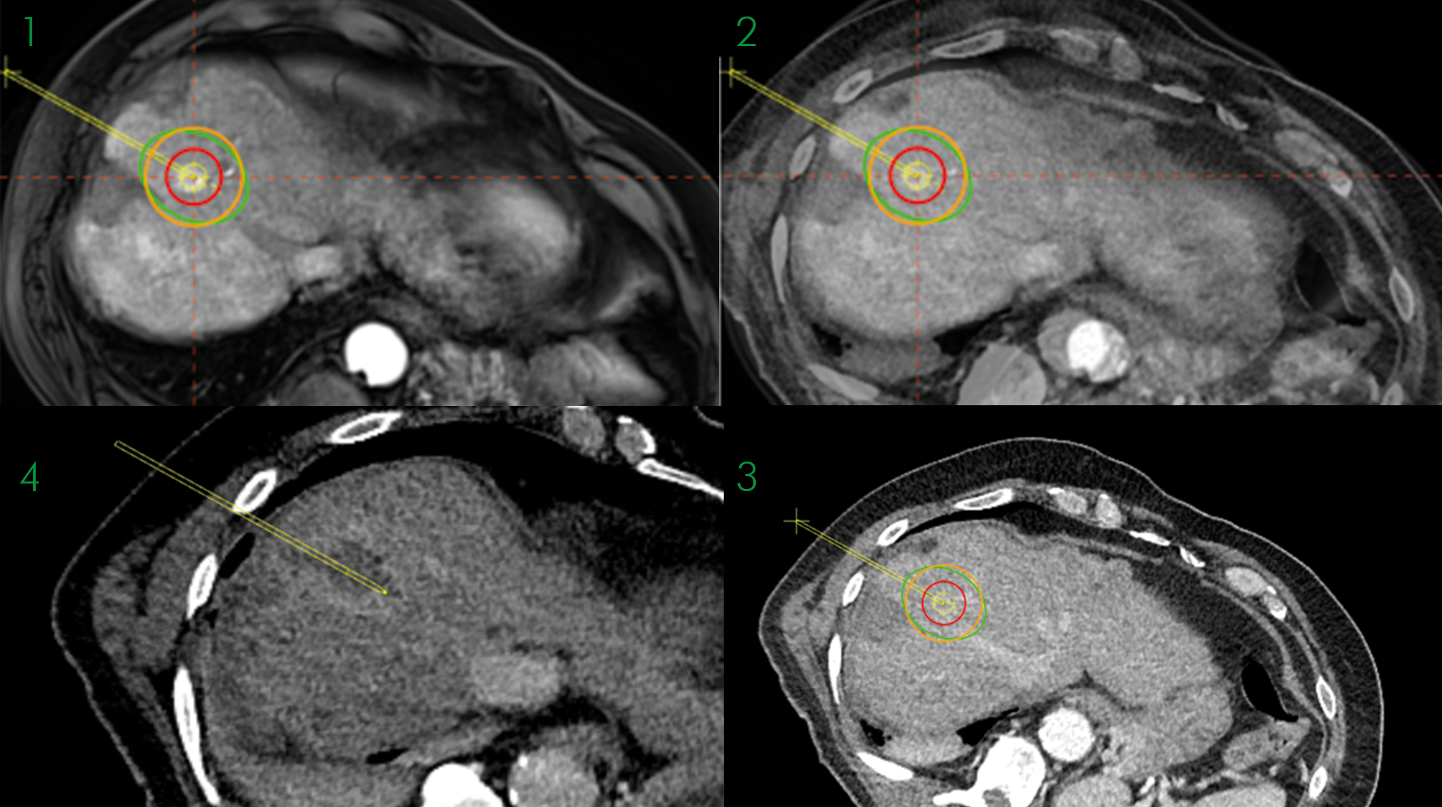 Ablation of "invisible" Lesion in Segment VIII