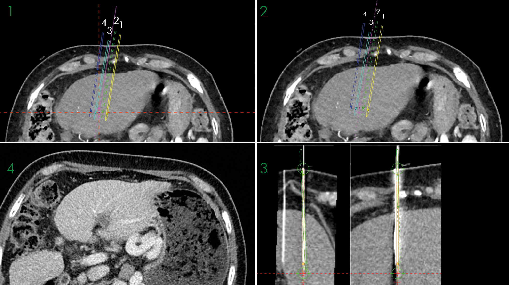 Navigated Irreversible Electroporation of Hepatocellular Carcinoma