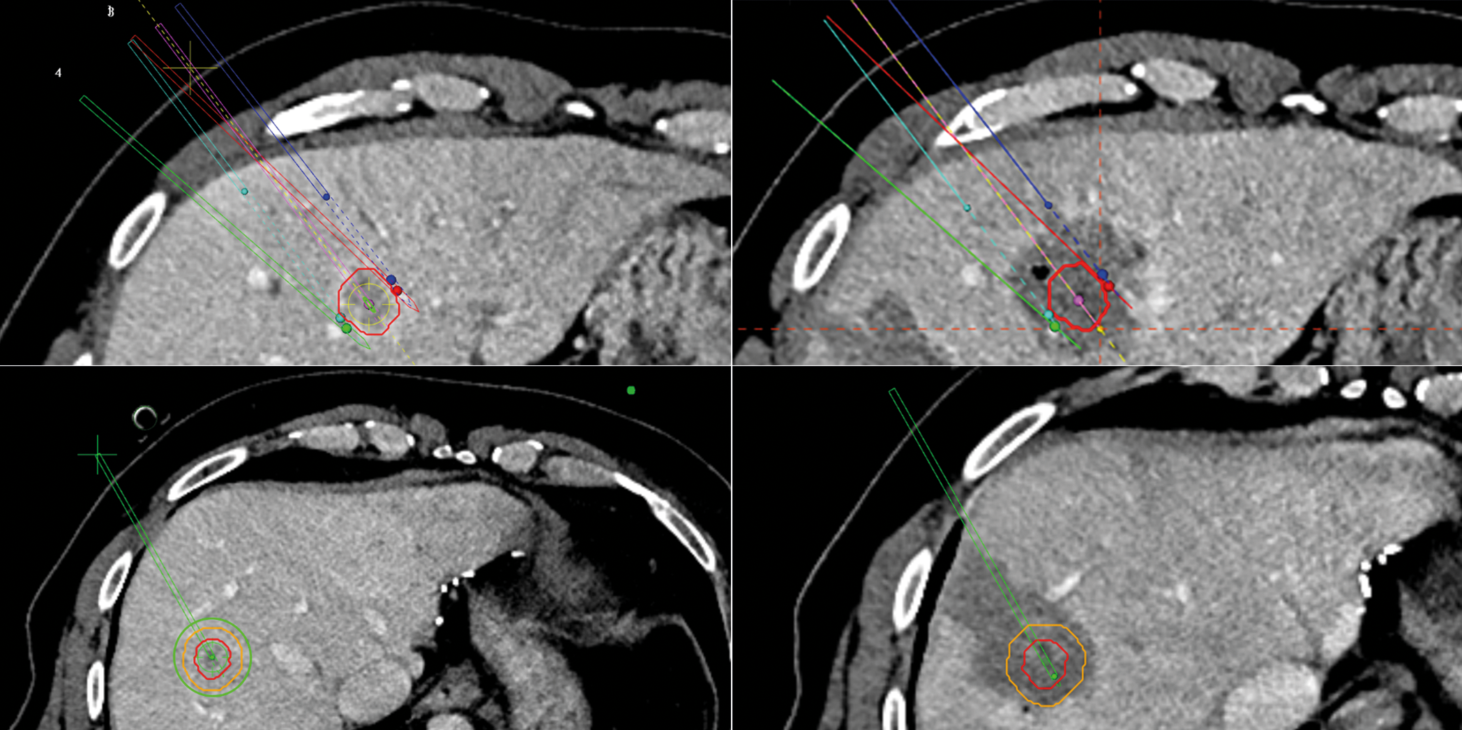 Combined IRE and MWA for two local HCC recurrences in Seg. IVa + VIII