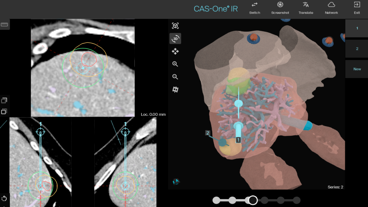 A highly angulated trajectory for a liver dome lesion on the capsule ...