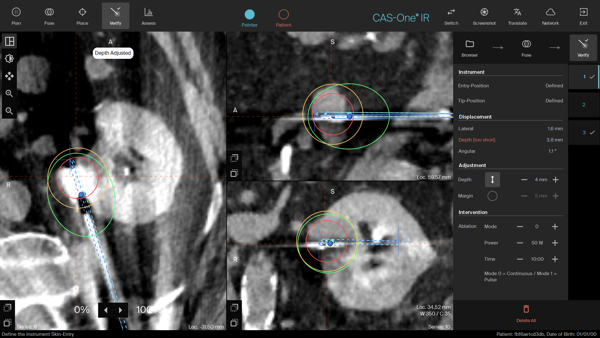 Two-probe MWA of RCC lesions in different locations