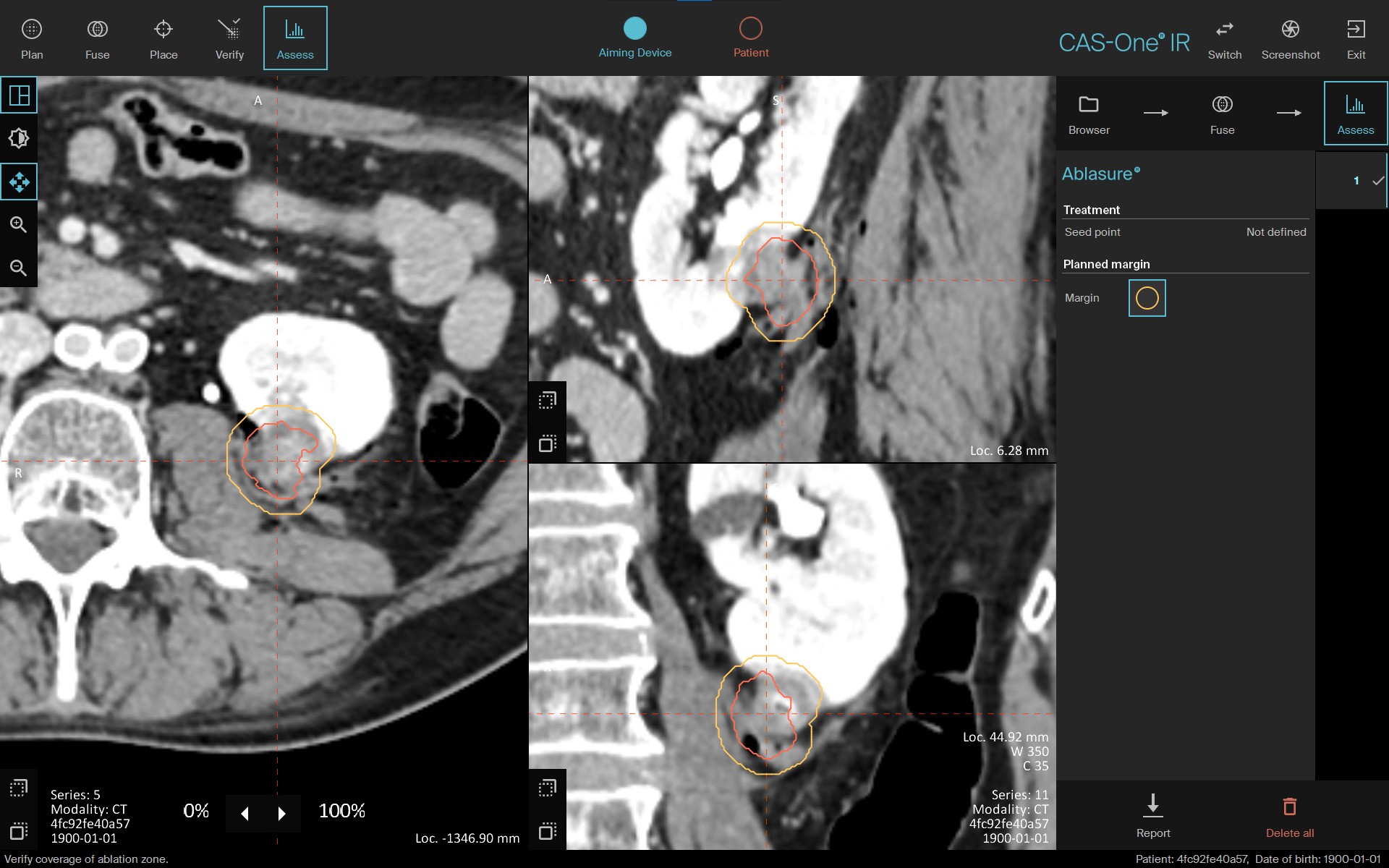 MWA of the Kidney with CAS-One IR