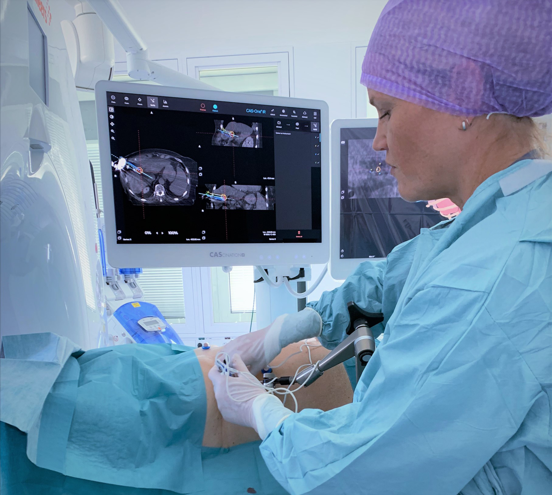 The first cases of the new AI-driven CAS-One IR are in the books!