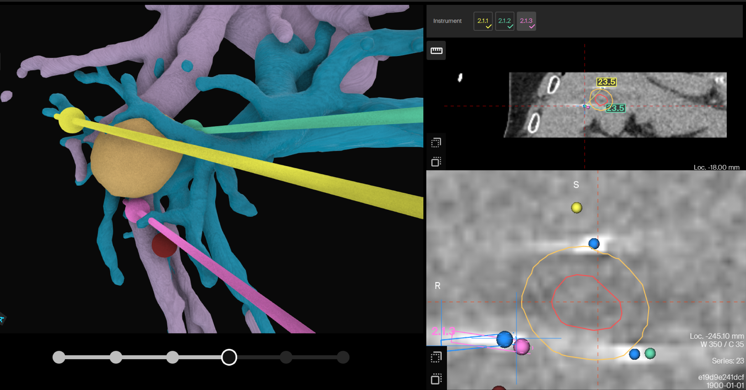 Electrochemotherapy of two lesions in segment IVa